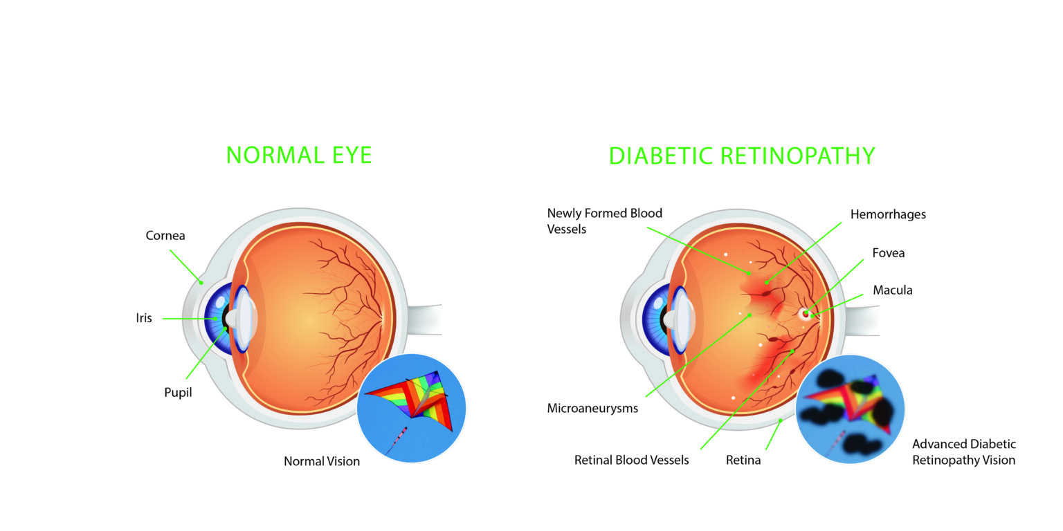 Diabetic Eye Exams • Community Care Family Medicine